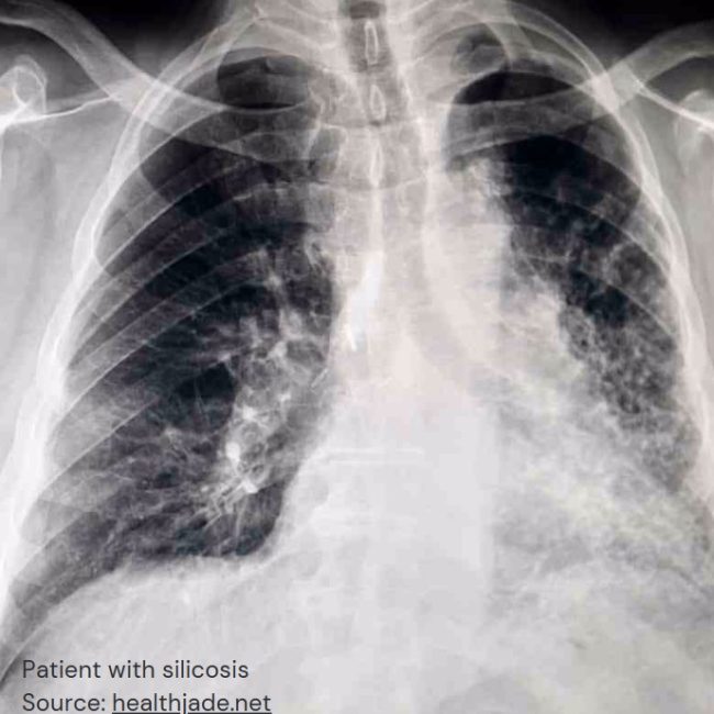 Let’s Talk About Silicosis | Brisbane Benchtops
